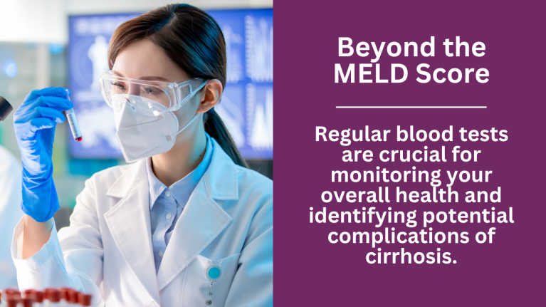 Living with Cirrhosis PT 3: Understanding Your MELD Score – Gay in the CLE