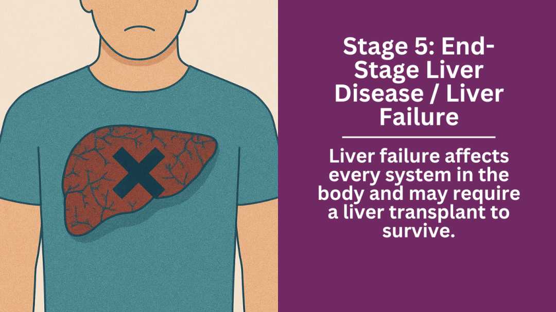 Understanding the Stages of Cirrhosis: From Fatty Liver to Liver ...