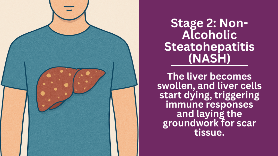 Understanding the Stages of Cirrhosis: From Fatty Liver to Liver ...